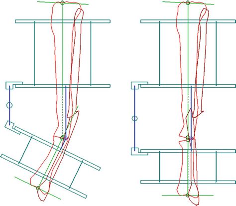 First Stage Computerized Preoperative Planning Of Tibial Recurvatum Download Scientific Diagram