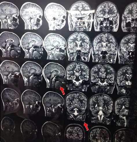 Diffuse Multiple Cystic Lesions In The Brain Spot Diagnosis