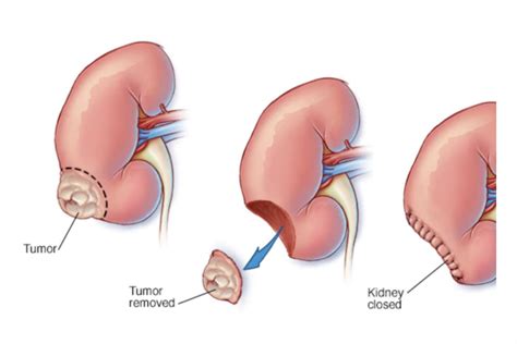 Laparoscopic And Robotic Partial Nephrectomy Dr Anand Arumugam