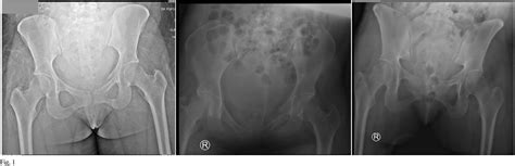 Figure 1 From Pathologic Pubic Symphysis Diastasis In Pregnant Pelvic Ring Fracture Treated With