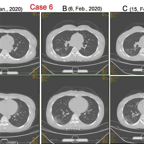 Chest Ct Imaging Of Patient 6 A Patchy Ground Glass Opacity And Mesh