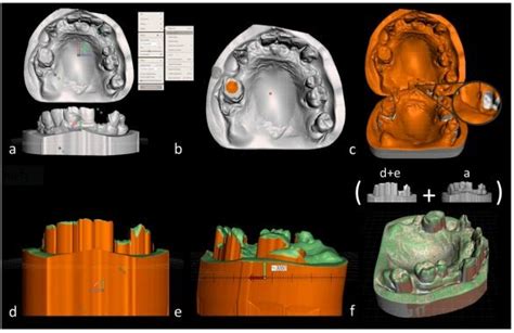 Workflow Used To Identify The Undercuts And Blocking Out The Maxillary Download Scientific