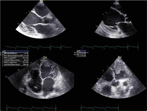 Echocardiogram Showing Biventricular Enlargement With Depressed Left