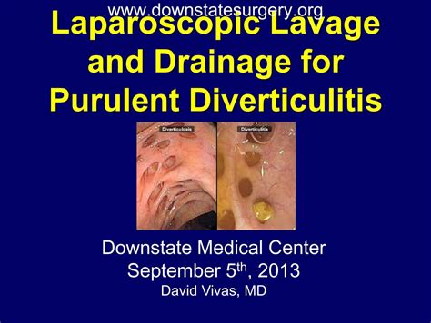 Laparoscopic Lavage And Drainage For Purulent Diverticulitis