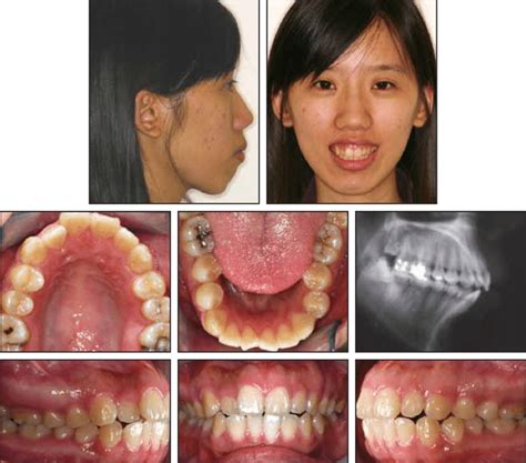 Case 2 22 Year Old Female Patient With Protrusive Profile And