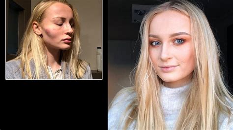 Belçikalı Model Anthonia Rochus Sevgilisinden Gördüğü şiddeti