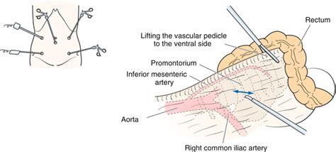 Laparoscopic Sigmoidectomy Abdominal Key