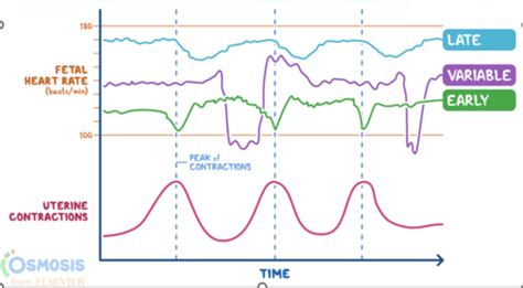 Fetal Heart Rate Monitoring Flashcards Quizlet