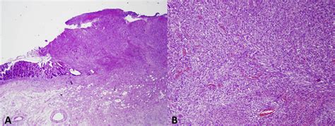 Histologic Features Of An Ileocecal Valve Pseudotumor A At Low Power