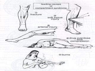 Compartment Syndrome Powerpoint Presentation Ppt Free Download
