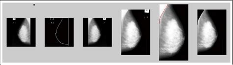 figure 2 from deep learning algorithm for breast masses classification