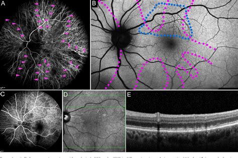 Figure 1 From Localized Reticular Pseudodrusen And Their Topographic Relation To Choroidal
