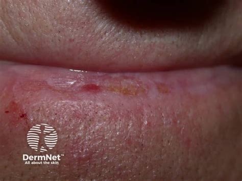 Actinic Keratosis Lip