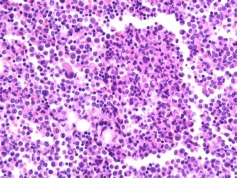 Bone Marrow Of The Femur In Case 2 Hypercellularity Characterized By Download Scientific