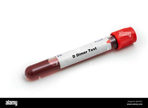 D Dimer Test Medical Check Up Test Tube With Biological Sample Stock