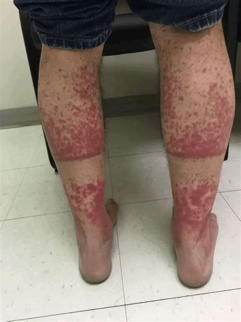 Livedo Reticularis When Skin Patterns Reveal More Than Meets The Eye
