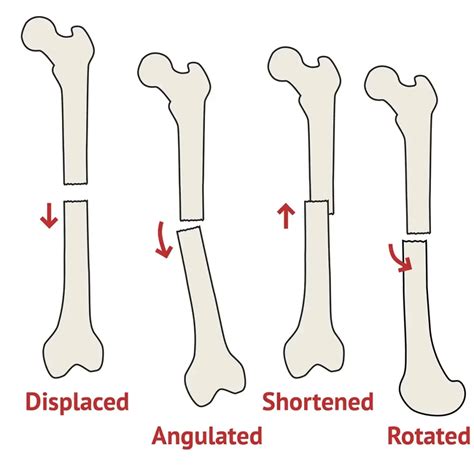 Fracture Displacement Types Risks And Complications