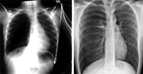 Chest Imaging Flashcards Quizlet