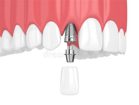 3d Render Of Upper Jaw With Teeth And Dental Lateral Incisor Imp Stock