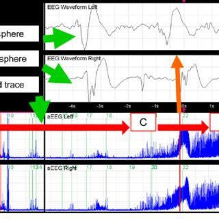 Predominant Background AEEG Pattern At Each Phase Of Recording The Download Scientific Diagram