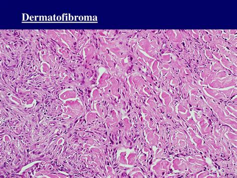 Ppt Soft Tissue Tumors Powerpoint Presentation Free Download Id146428