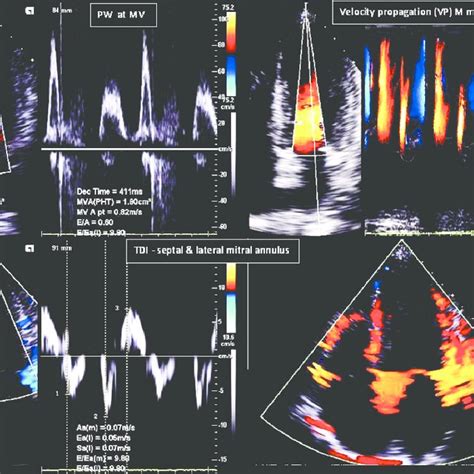 Pdf Diastolic Dysfunction In Asymptomatic Type 2 Diabetes Mellitus