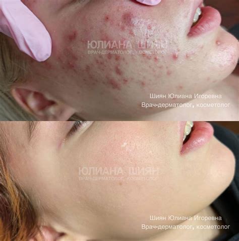 Лечение акне результаты и советы врача