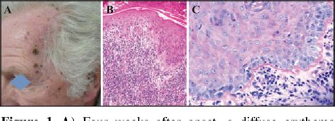 Figure 1 From Cross Reactivity Of Cephalosporins Allergic Immediate Hypersensitivity To