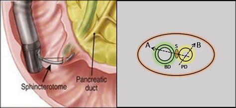 Biliary Sphincterotomy Definition Bovs