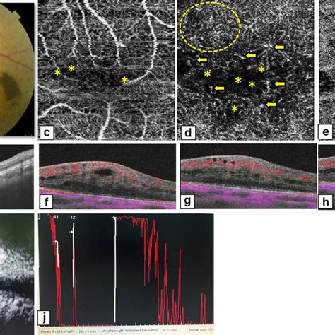 3 × 3 Ss Oct Angiograms Of The Superficial Capillary Plexus A Deep