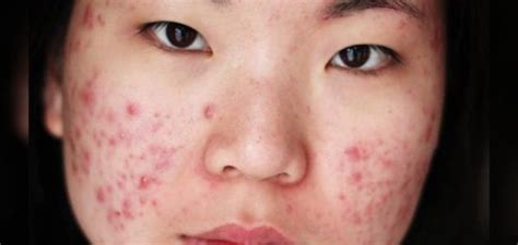 أنواع حب الشباب موضوع