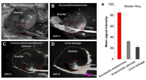 Nir Iia Anterograde Ureterography In Renal Transplantation Based On Download Scientific Diagram