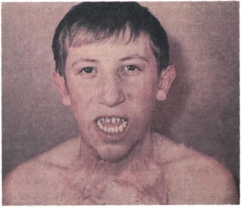 Истината за възпалени лимфни възли Здраве Ws