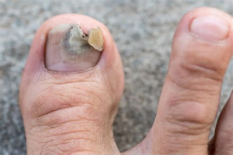 Toenail Fungus Treatment Podiatric Solutions For Onychomycosis