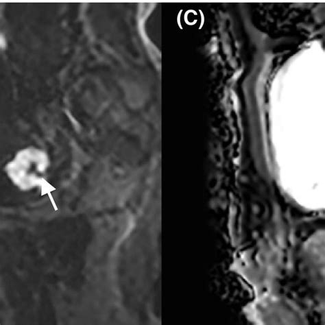Images In A Patient With An Exophytic Tumor Located At The Bladder