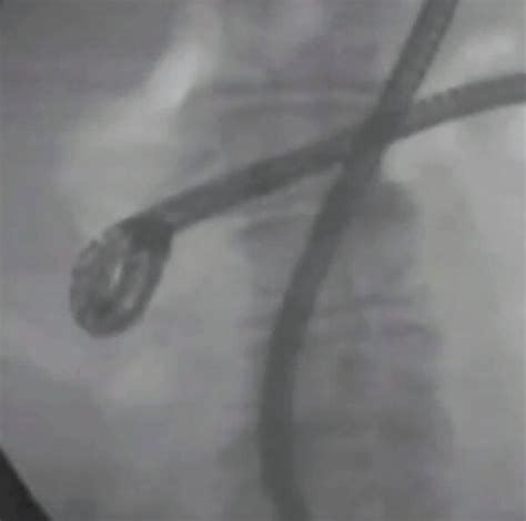 Creation Of The Alpha Retroflex Scope Position The Scope Is