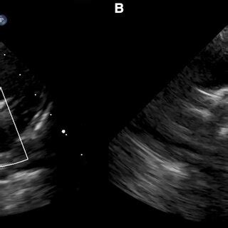 A Transthoracic Echocardiogram A Color Doppler Flow Not Registered Download Scientific