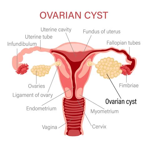 Best Laparoscopic Ovarian Cyst Removal In East Delhi Noida