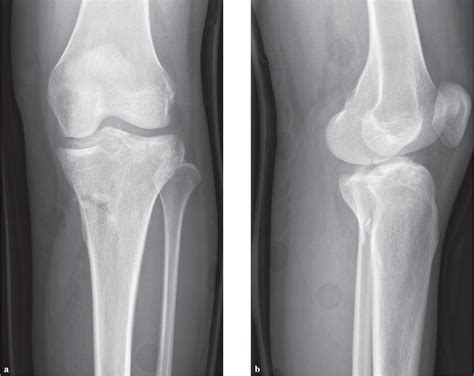 Tibia Compression Fracture Treatment Nojoker