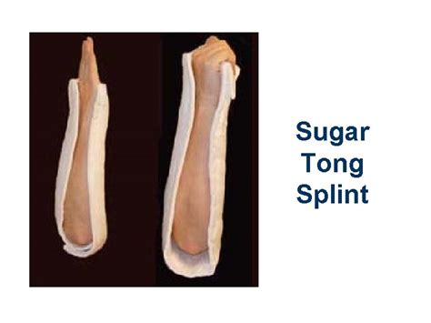 Splinting Immobilization Learning Objectives Appropriate Immobilization
