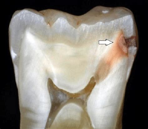 Dental Caries In Cross Sectional View Download Scientific Diagram