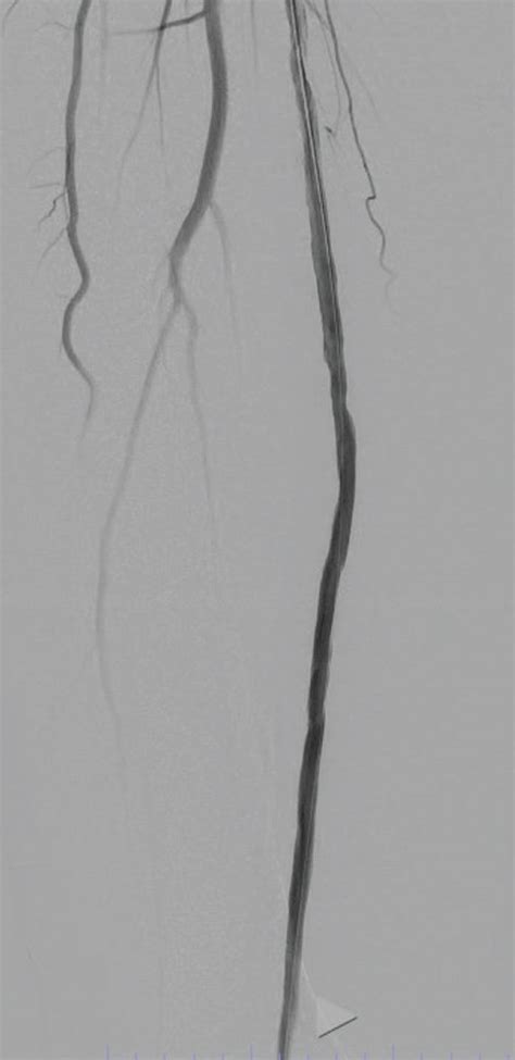 Case Report Long Segment Sfa Stenosis With Cto Treated With Serranator® And Dcb In A Patient