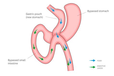 Operation Gastric Bypass Discover Weight Loss Operation Gastric Bypass Discover Weight Loss