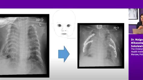 Nmt Helping To Optimize Recovery From Anesthesia Clinical View