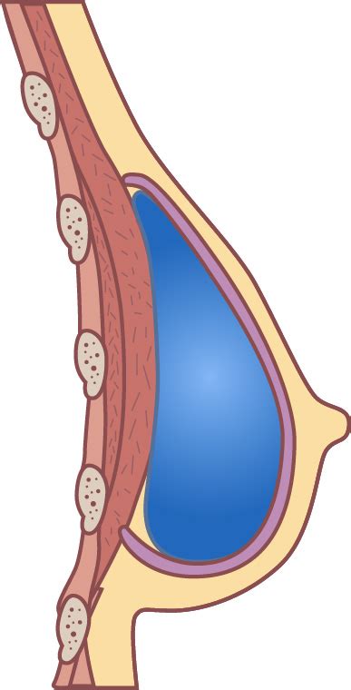 Implants Prepectoral Breast Reconstruction Vs Subpectoral Breast Reconstruction