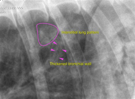 Rad Healed But Recurrent Aspiration Pneumonia With Chronic Airway