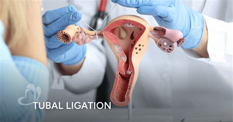 Tubal Ligation Thomson Medical