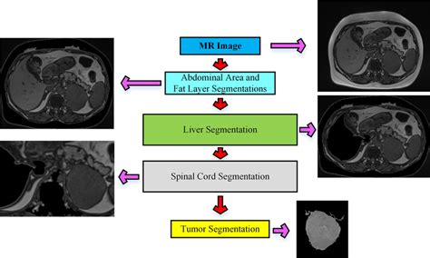Semiautomatic Segmentation Method On Adrenal Tumor Data Set Mr Download Scientific Diagram