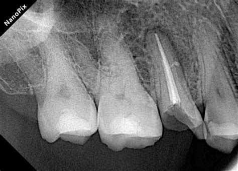 Dr Mahmoud Nader On Linkedin Daily Routine ️ Treatment Of Upper Premolar