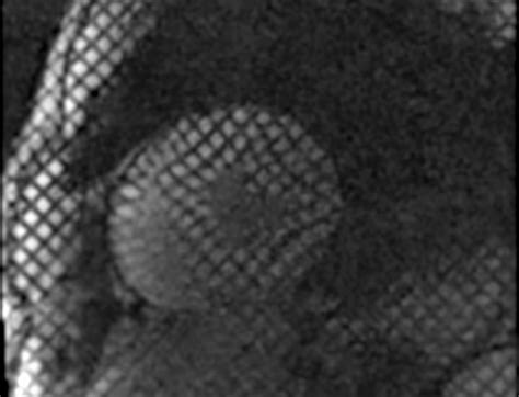 Example Of Cmr Tagging With A Spatial Modulation Of Magnetization Download Scientific Diagram